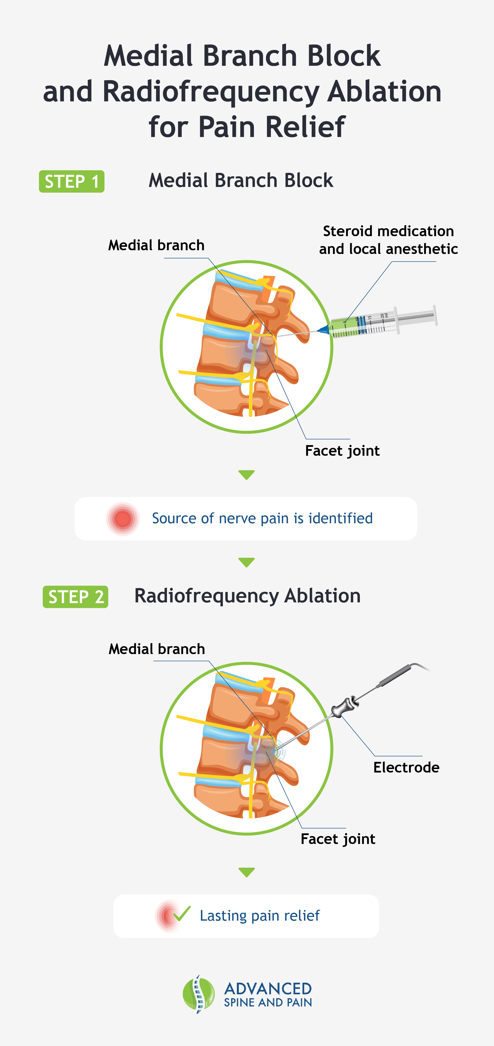 Medial Branch Block and Radiofrequency Ablation | Advanced Spine and Pain